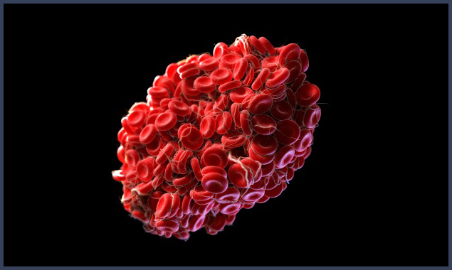 VIDEO: Measurement of ADAMTS13 Activity is Useful in Suspected ... VIDEO: Measurement of ADAMTS13 Activity is Useful in Suspected ...