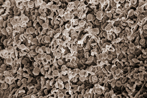 HLA Induced Refractoriness to Platelet Transfusions - Transfusion News